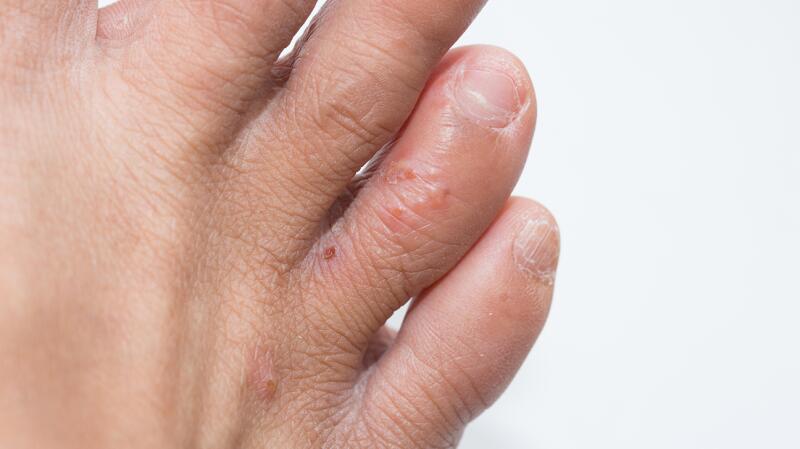 Dyshidrotic Eczema: Symptoms, Causes, and More