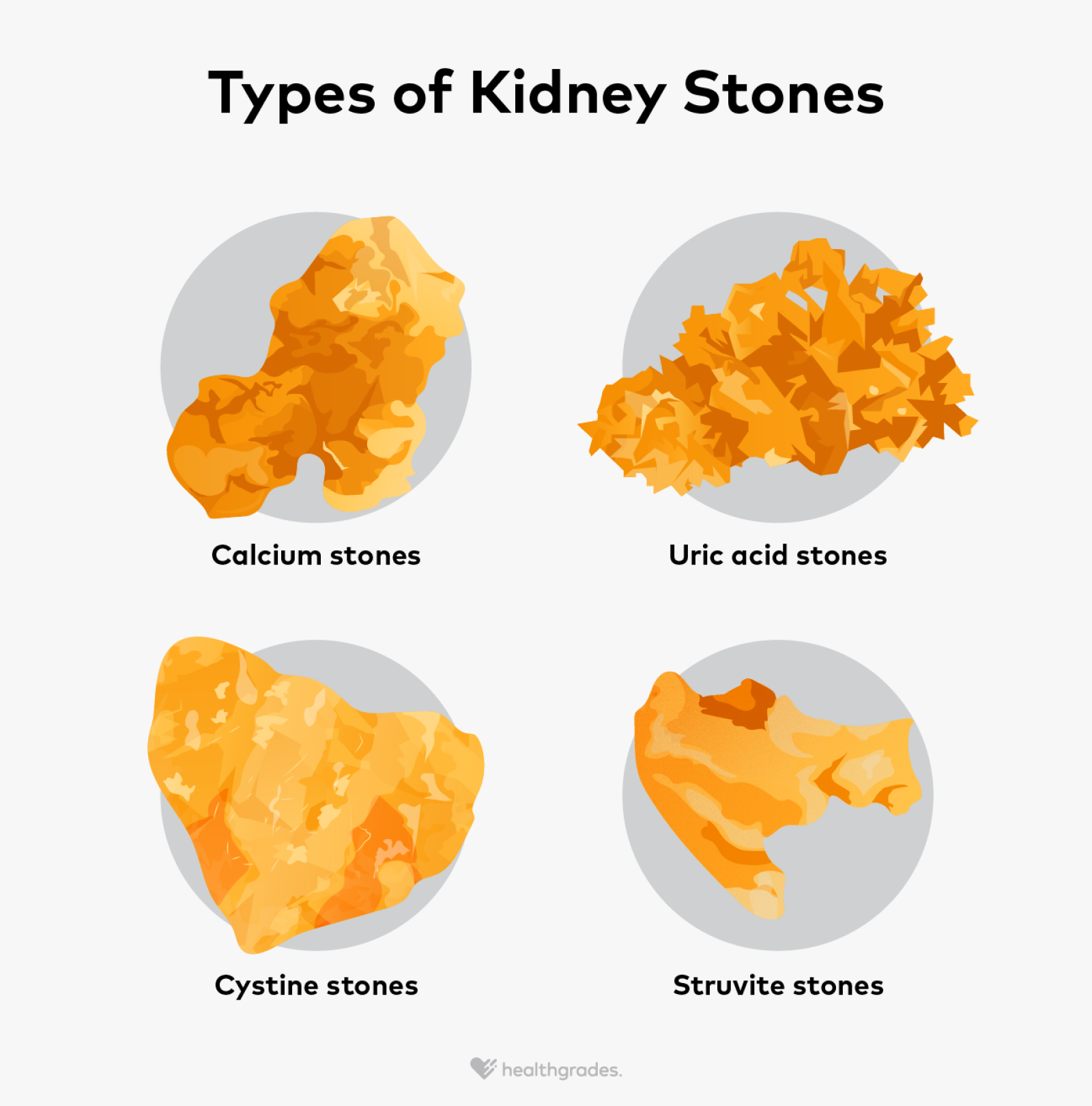 Types Of Kidney Stones Definitions Symptoms And Treatments Types Of Kidney Stones Definitions Symptoms And Treatments