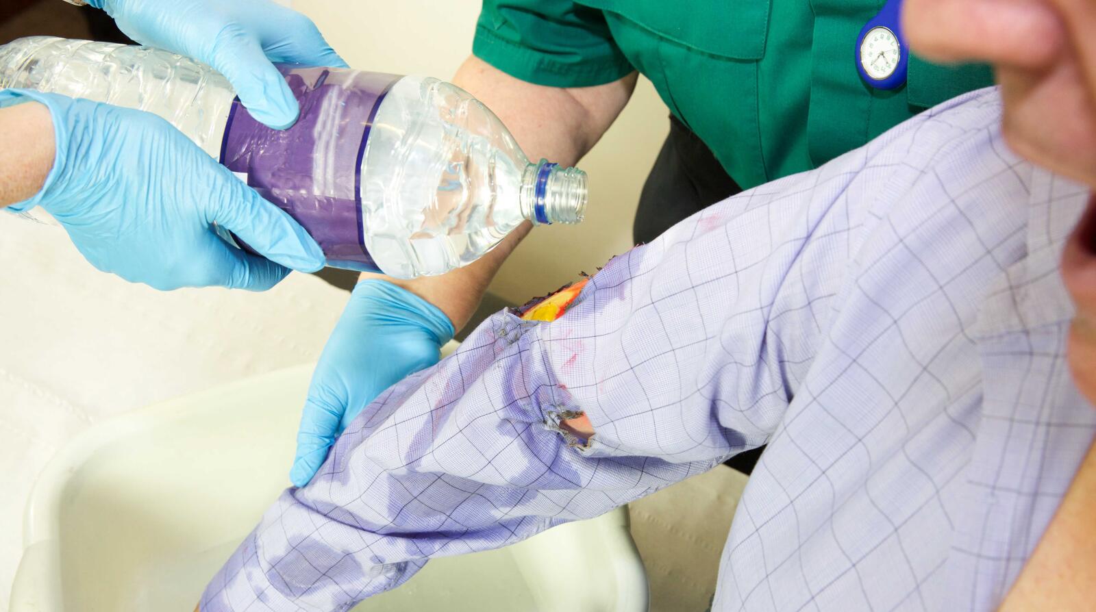 10 Things to Know About Burns | How to Treat 2nd and 3rd Degree Burns