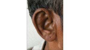 Alkaptonuria: Definition, Causes, Treatments, and More