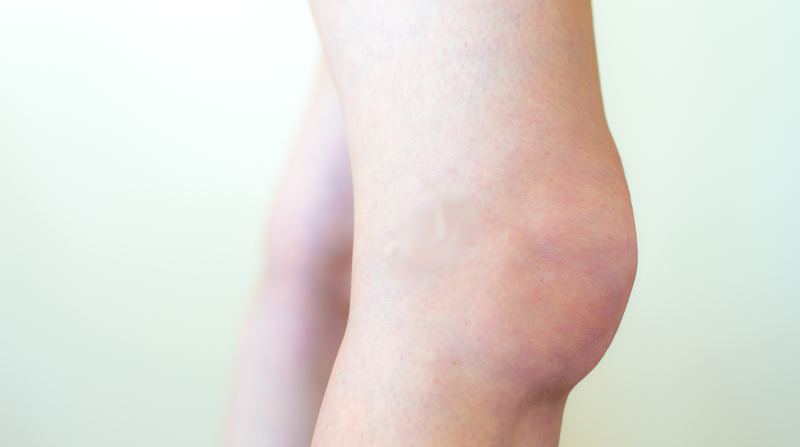 Rare Causes of Knee Pain | Knee Pain Without Injury