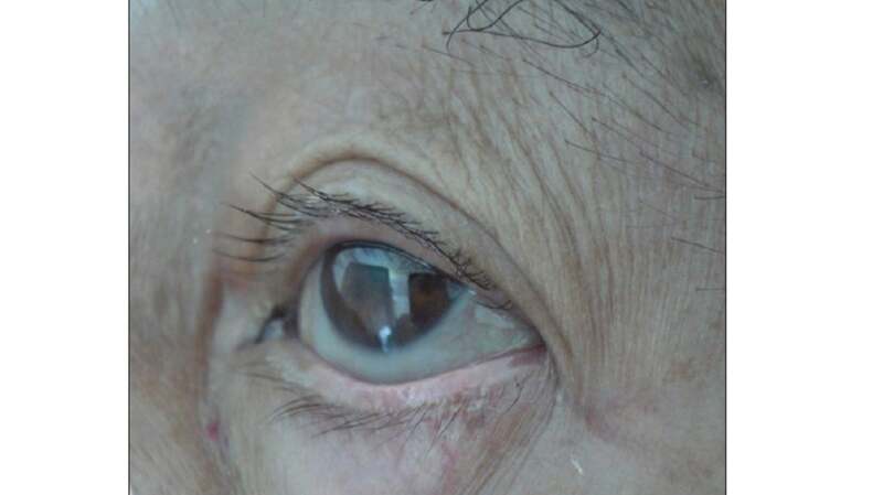 Argyria: Definition, Symptoms, Causes, Treatments, and More