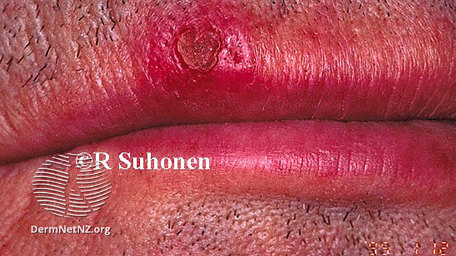 Lip Cancer: Symptoms, Diagnosis, Treatment