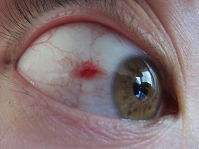 Subconjunctival Hemorrhage: Symptoms, Causes, Treatments