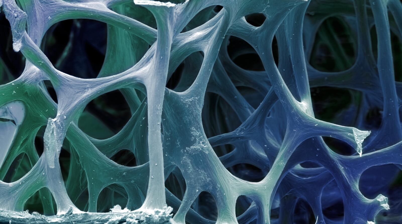 8 Things to Know About Myelofibrosis