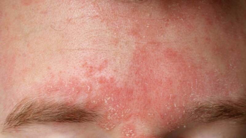 Facial Eczema: Symptoms, Causes, Treatments, and More