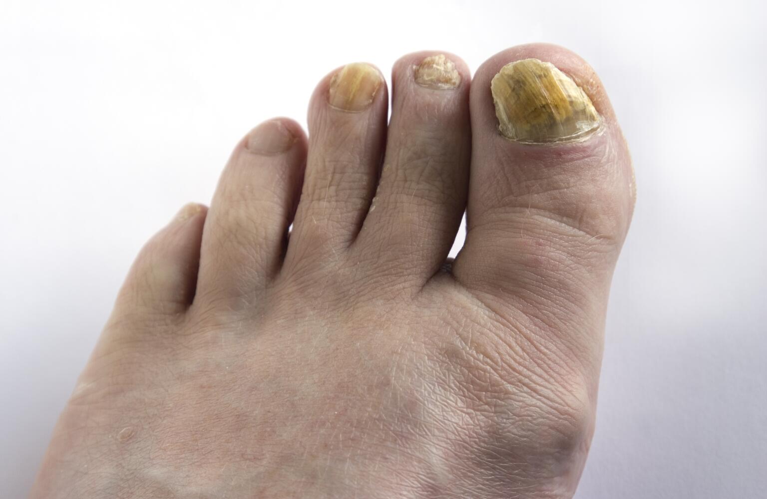 Toenail Problems: Fungus, Thickening & Yellow Toenails