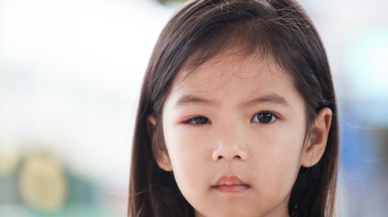 cellulitis face child
