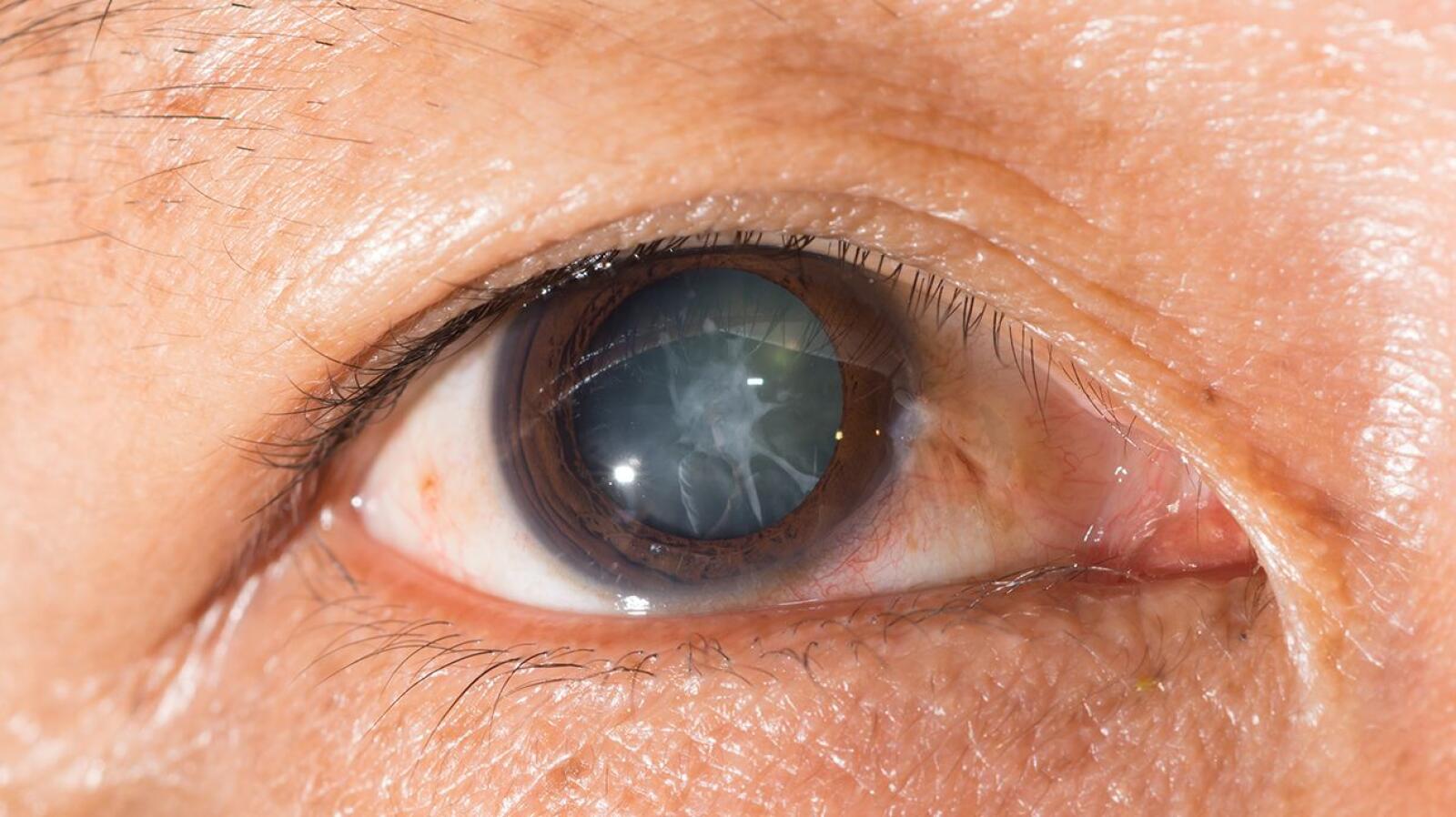 What Is a Cortical Cataract? Symptoms, Causes, and Treatment