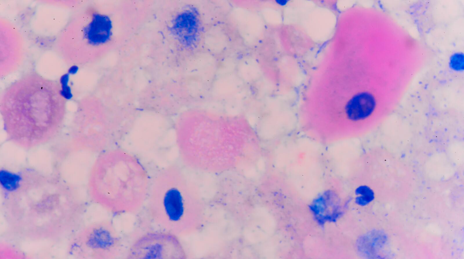 7 Rare Diseases That Affect the Blood