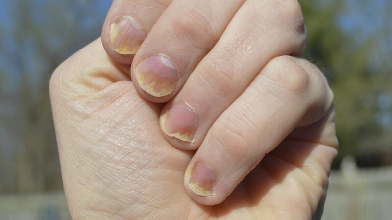 Yellow Nails: Causes, Treatment and Prevention