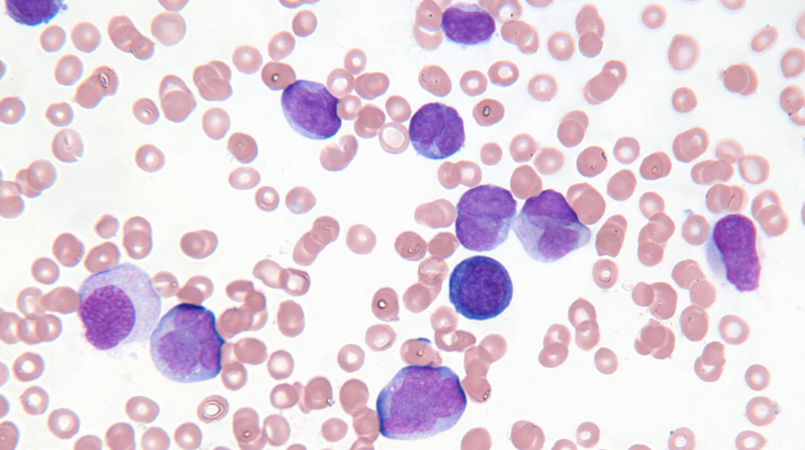 9 Surprising Facts About Leukemia