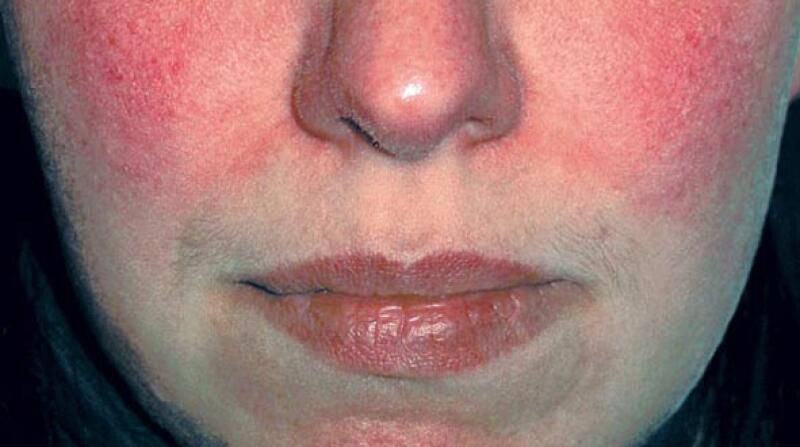 The Stages of Rosacea