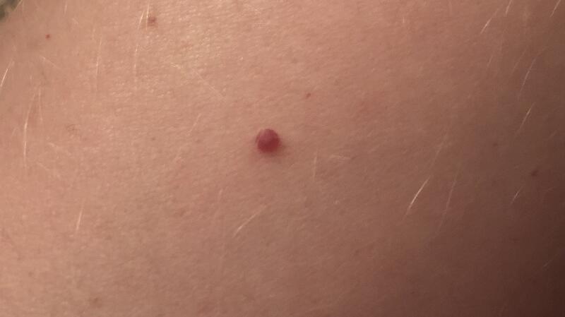 Cherry Angioma: Symptoms, Causes, Treatment, and Removal