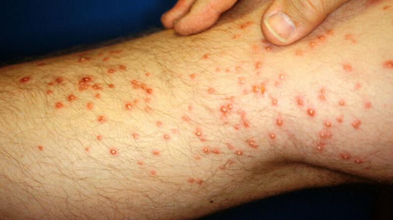 Ant Bites: Symptoms, Treatments, Prevention, and More