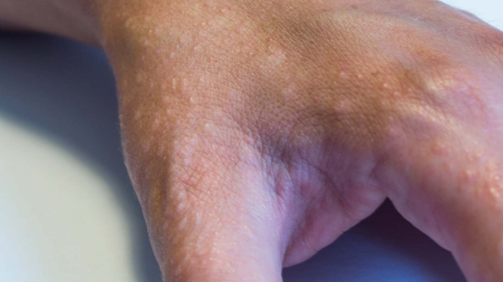 Eczema Blisters: Types, Causes, and Treatments