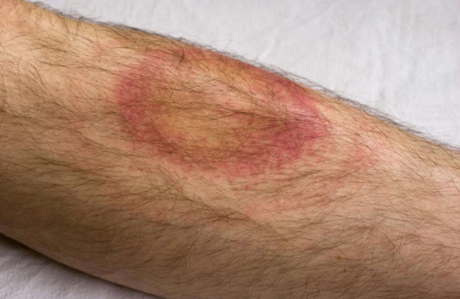 What Lyme Disease Looks Like