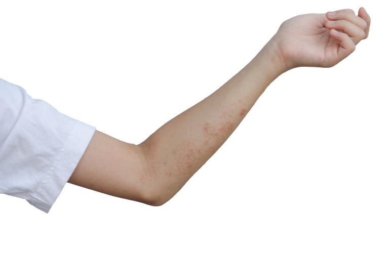 How Do You Get Scabies? | Frequently Asked Questions About Scabies