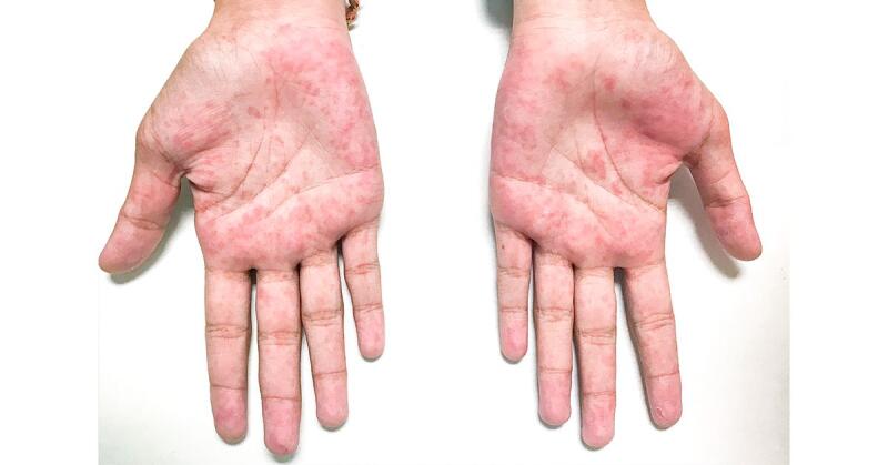 rashes on hands only