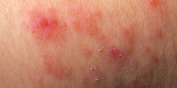 Itchiest Skin Conditions | What Skin Conditions Cause Itching?