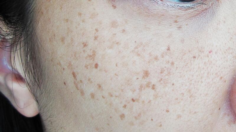 Sun Damaged Skin: Appearance, Causes, Treatments, and More