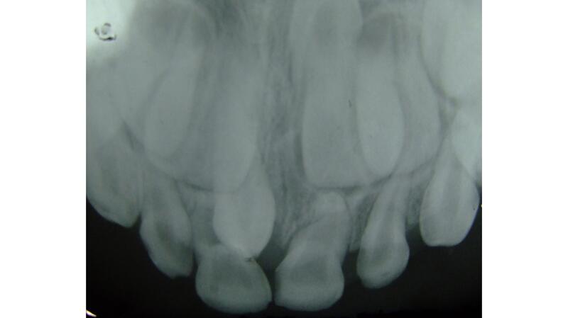 Mesiodens: Definition, Causes, Treatment, and More