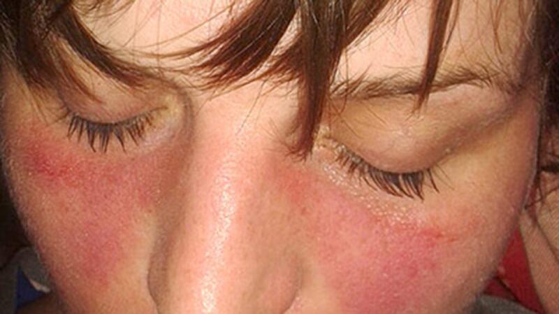 Red Spots on Skin - Causes and Treatment