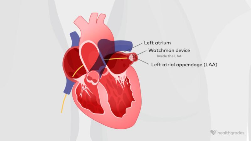 Watchman Procedure: Why It’s Done, Risks, and What to Expect Watchman Procedure: Why It’s Done, Risks, and What to Expect