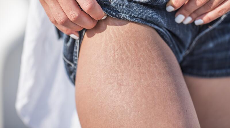 stretch marks menopause