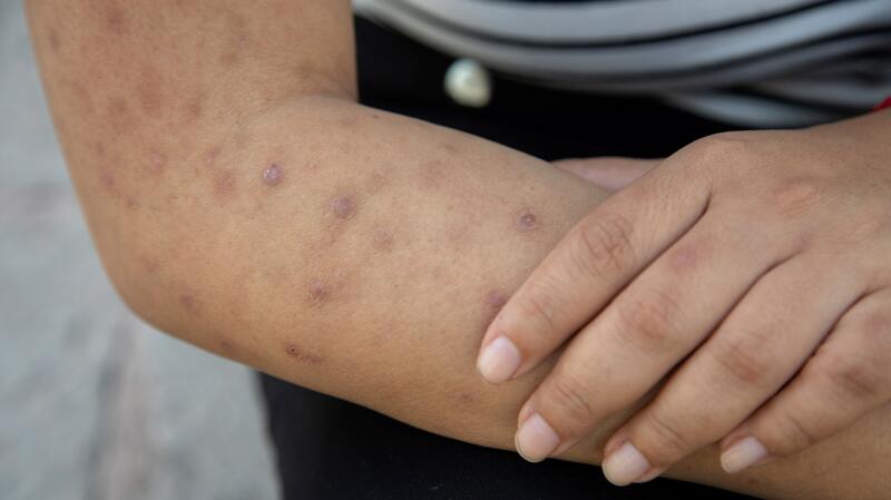 Prurigo Nodularis Pictures: Examples, Symptoms, and More