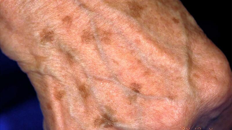Liver Spots: Causes, Symptoms, Treatments, and More