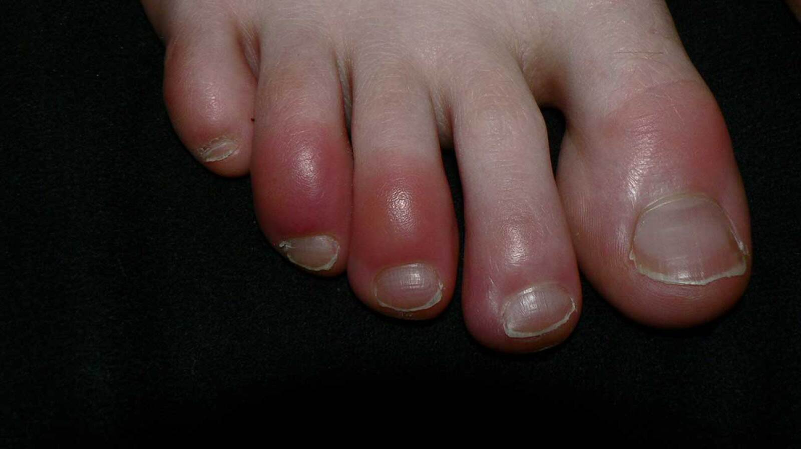 Frostbite: Symptoms, Treatment, and Prevention