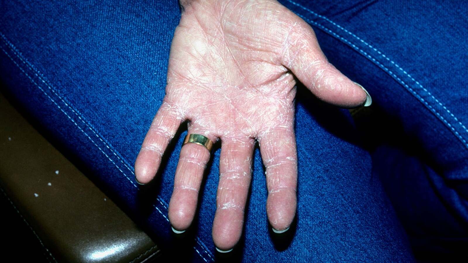 Tinea Manuum Symptoms Causes Treatment And More