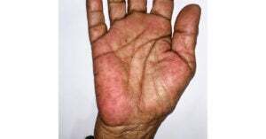 Rash On Palms: Causes, Treatments, and More