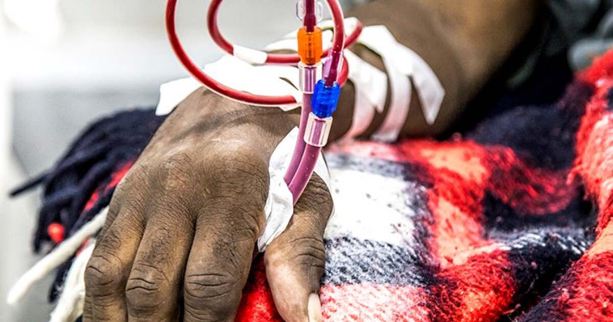 Dialysis Disequilibrium Syndrome: Symptoms and Treatments Dialysis Disequilibrium Syndrome: Symptoms and Treatments