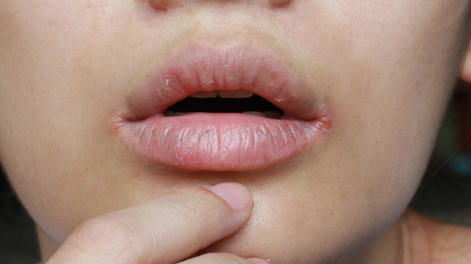 Chapped Lips (Cheilitis Simplex): Causes, Treatments, and Remedies