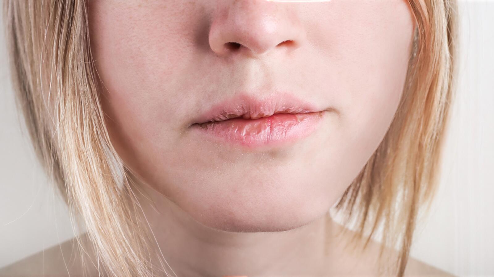 Chapped Lips (Cheilitis Simplex): Causes, Treatments, and Remedies