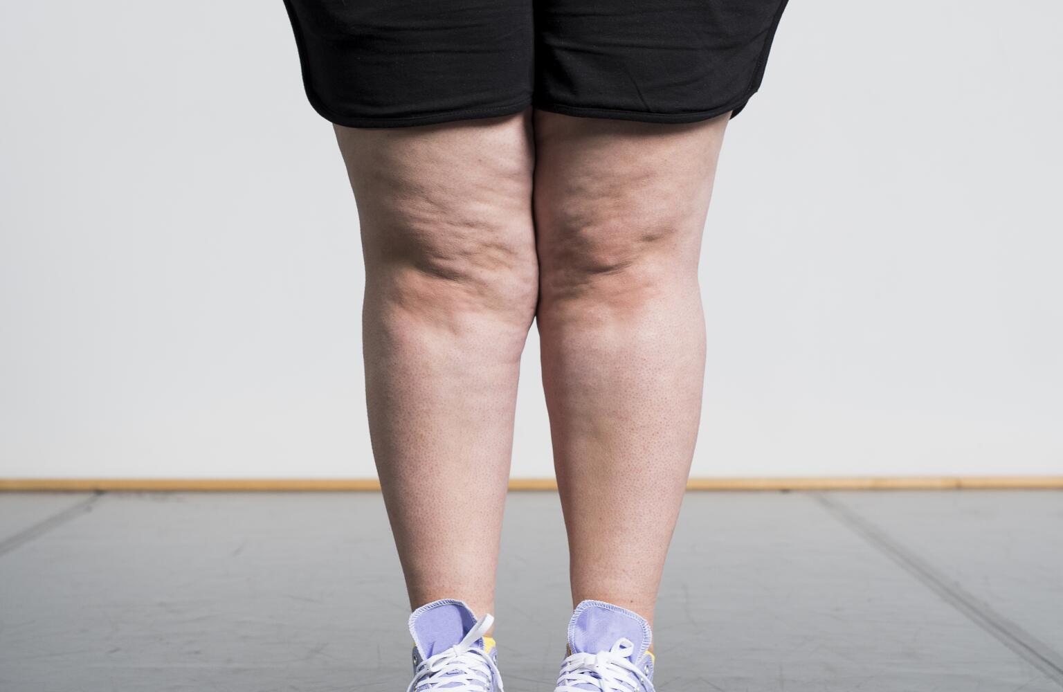 Understanding Hidradenitis Suppurativa of the Groin