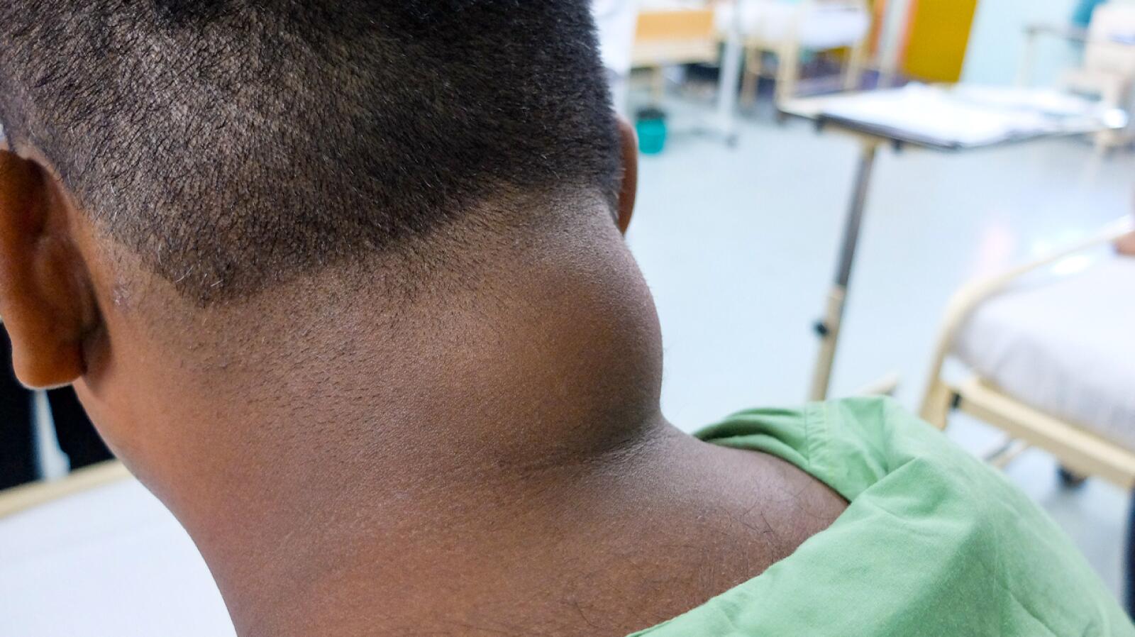 Dercum’s Disease: Pictures, Treatment, Outlook, and More