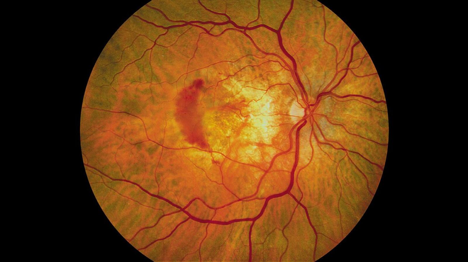 Stages of Macular Degeneration: Symptoms, Treatment, Outlook