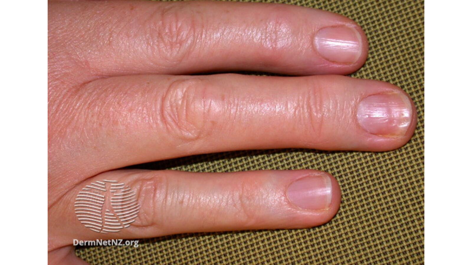 Dactylitis (Sausage Fingers): Causes and Treatments