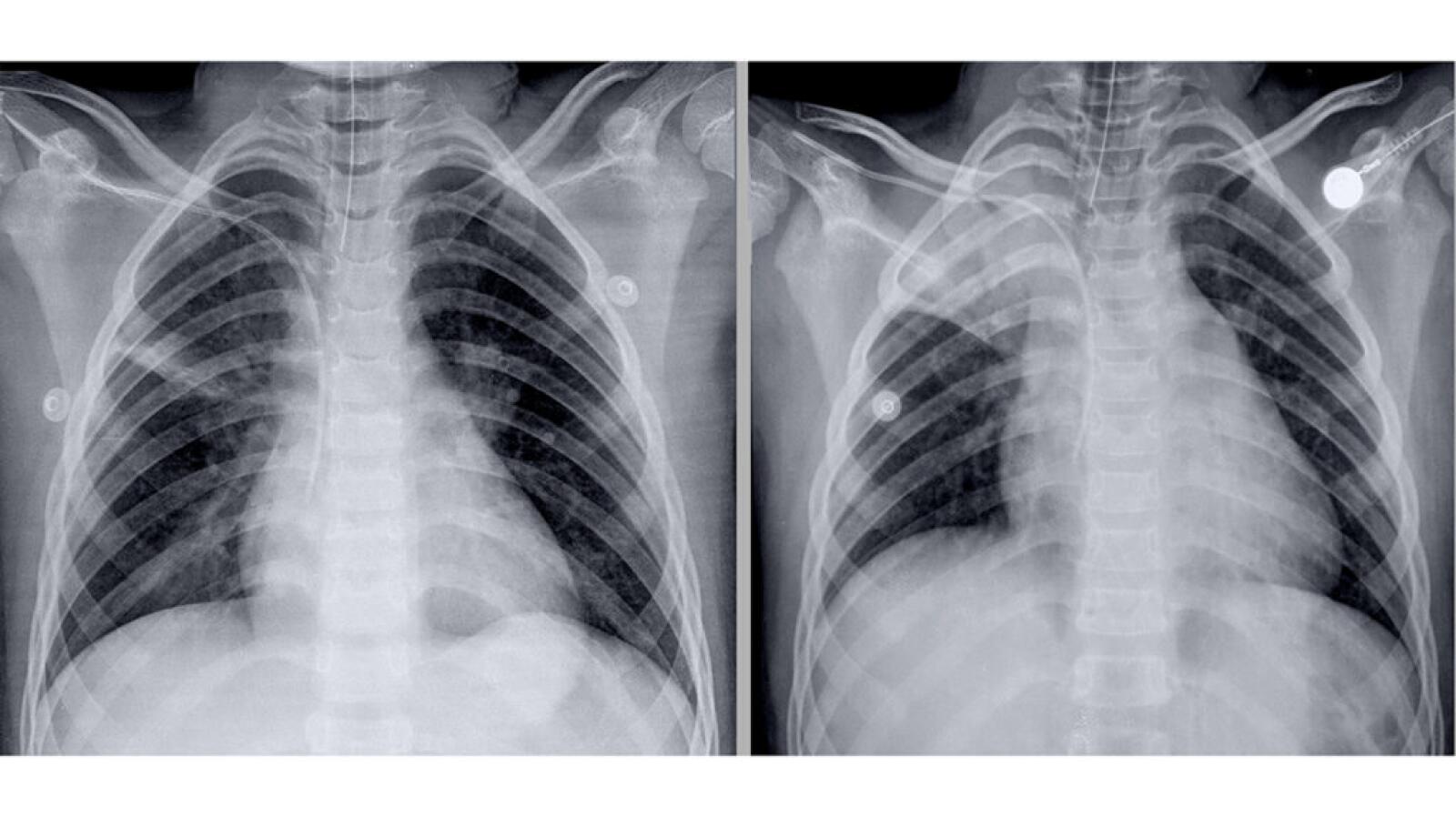 Atelectasis: Causes, Symptoms, Diagnosis, and Treatment