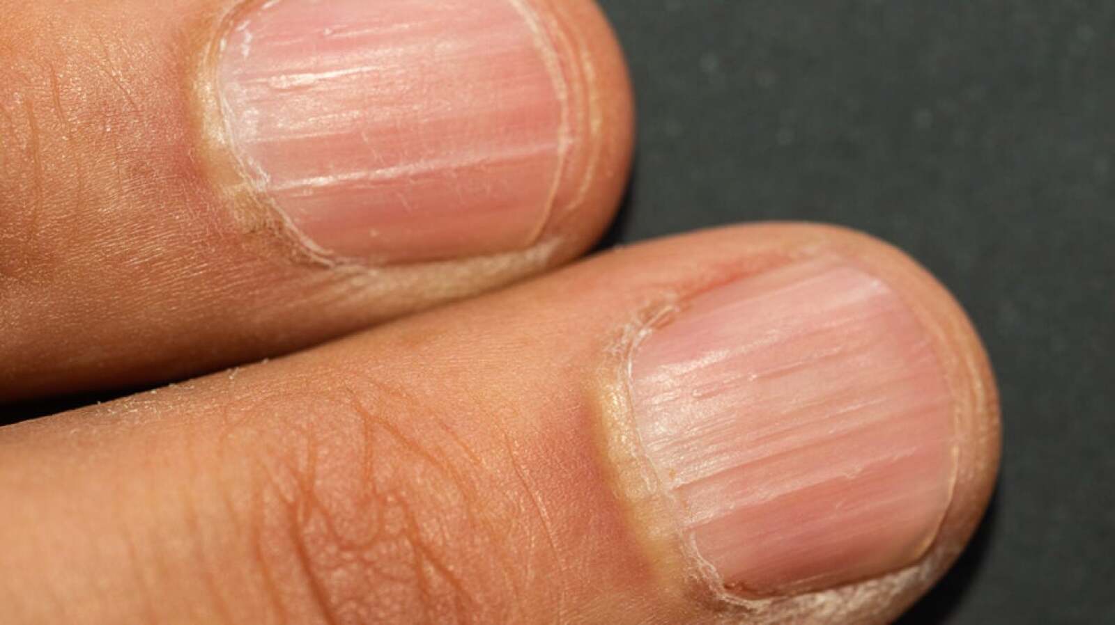 Onychorrhexis: Causes, Treatment, and More