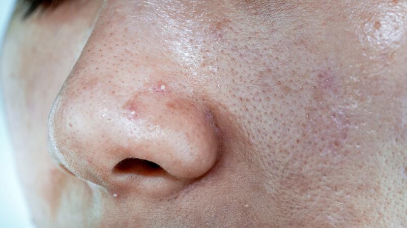 Sebum Plugs: Causes, Skin Health, and Safe Removal