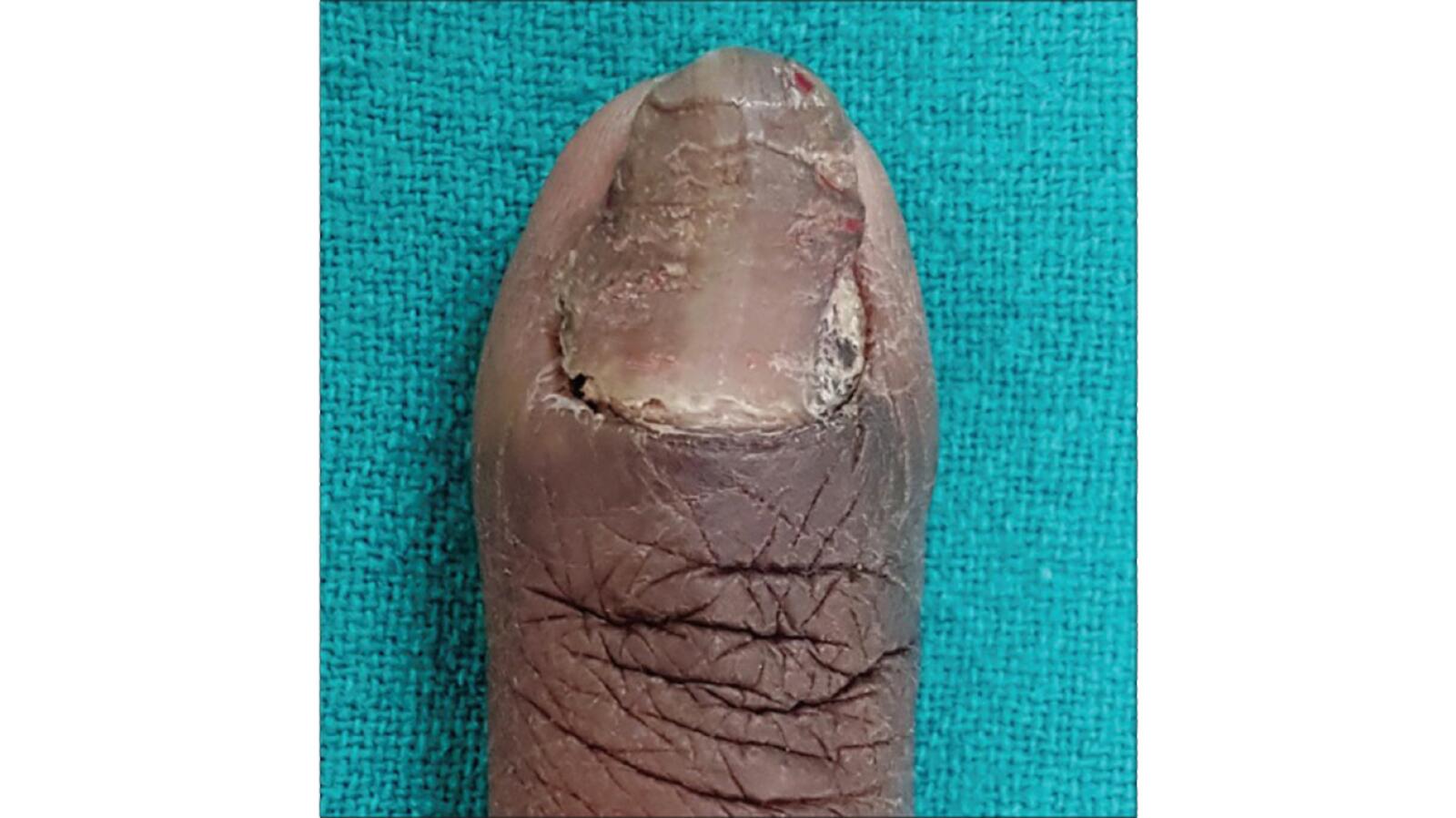 Melanonychia: Pictures, Types, Symptoms, Causes, and More