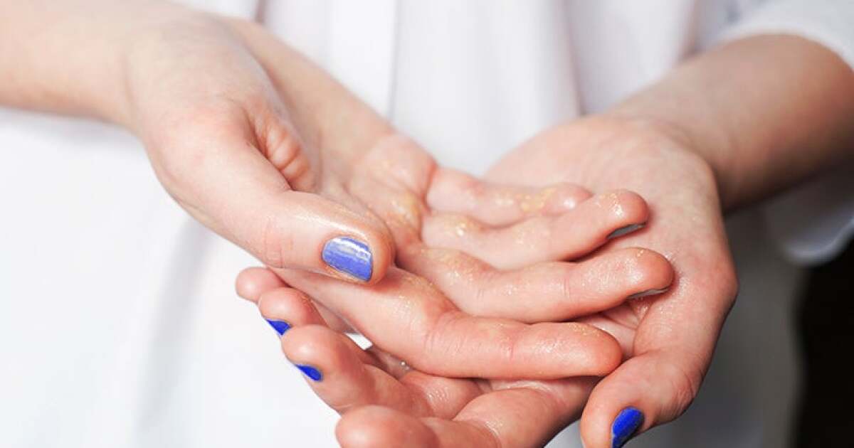 Cowden Syndrome: Definition, Symptoms, Treatments, and More