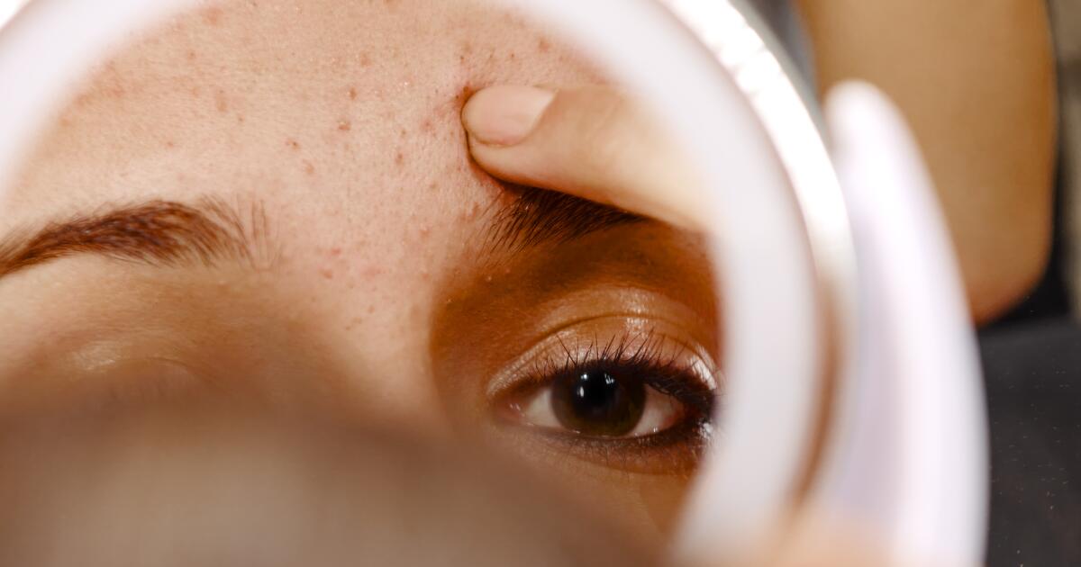 Pustules - Symptoms, Causes, Treatments