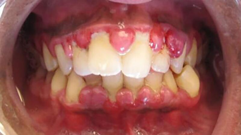 Gingival Hyperplasia: Causes, Treatment, Outlook, and More