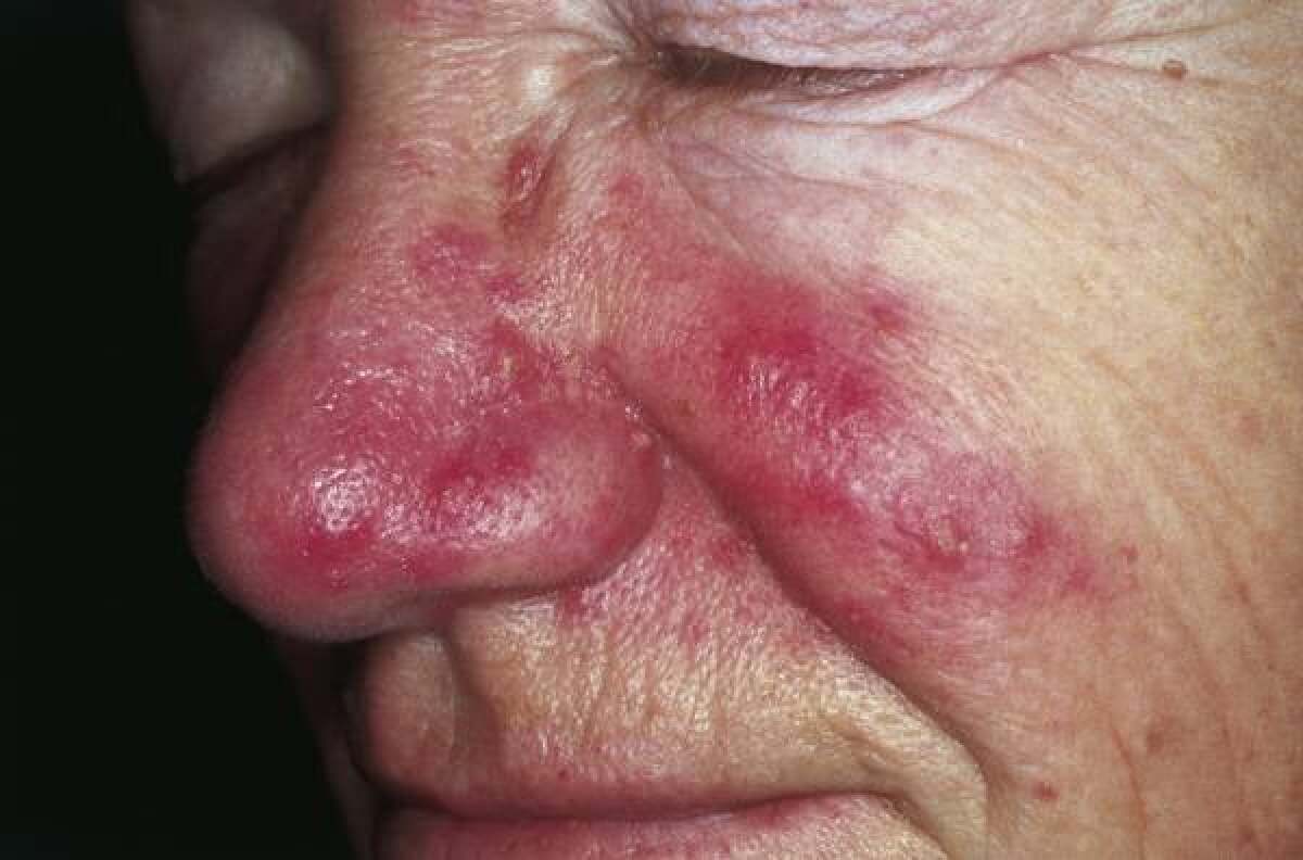 Lupus Rash vs. Rosacea: Symptoms, Causes, Treatments