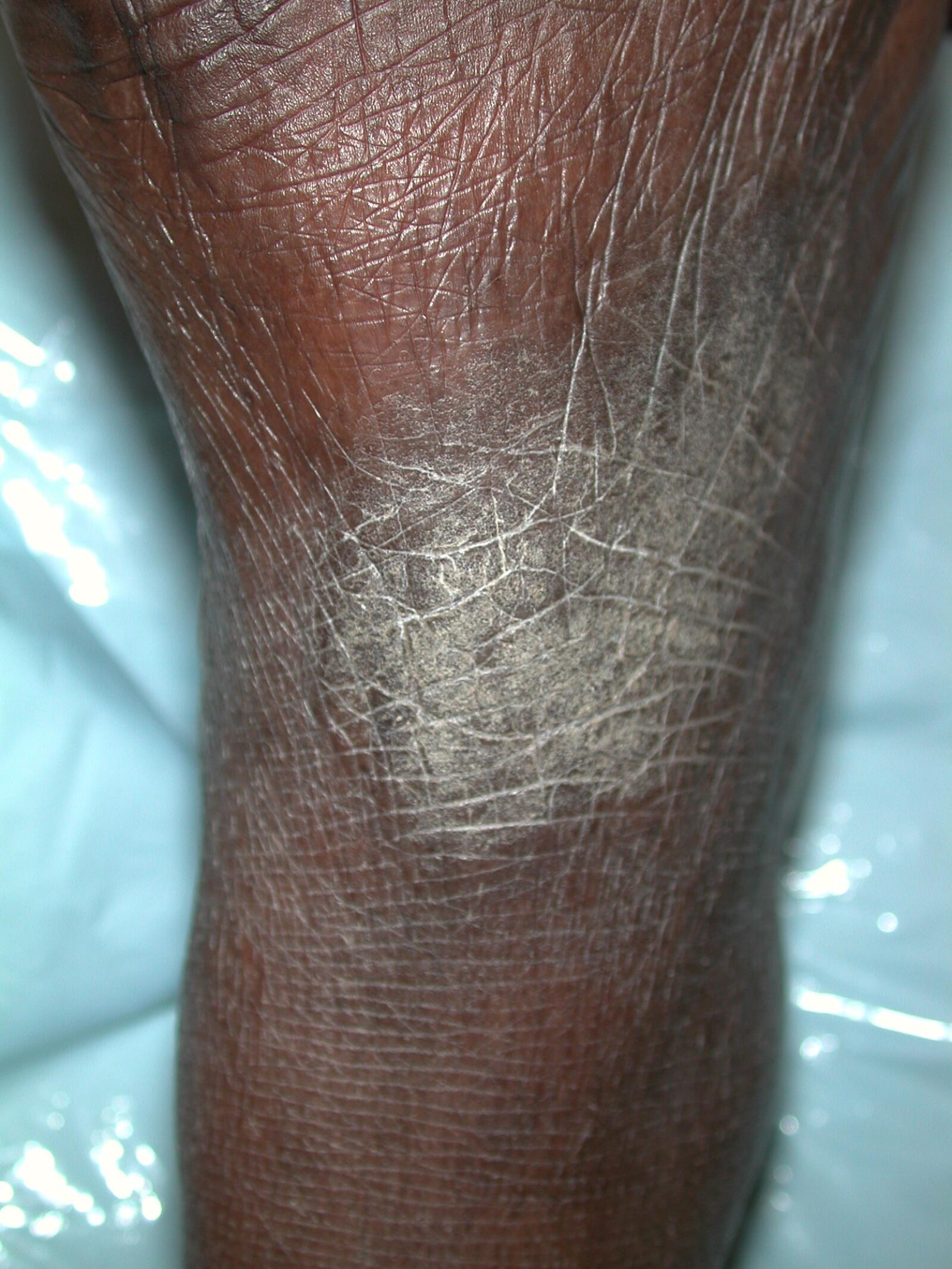 What Does Eczema Look Like? Pictures, Types, and More